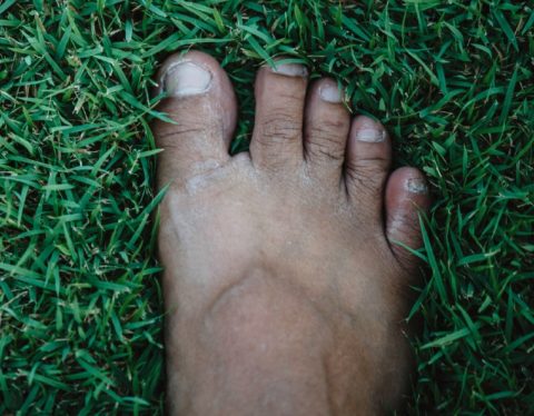 Turf Toe Treatment at Richardson Podiatry