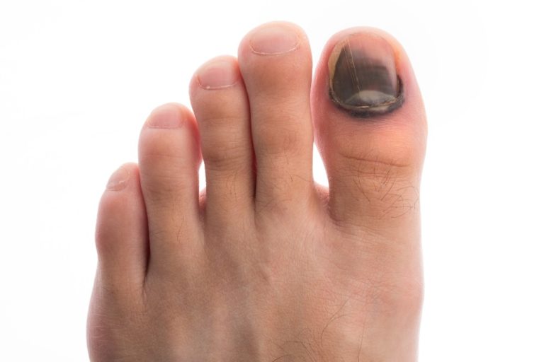Intro to Black Toenails | Richardson Podiatry Center