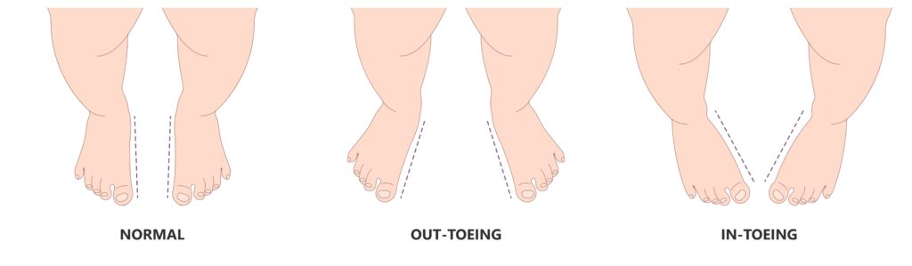 When to See a Doctor About My Child's In-Toeing and Out-Toeing ...