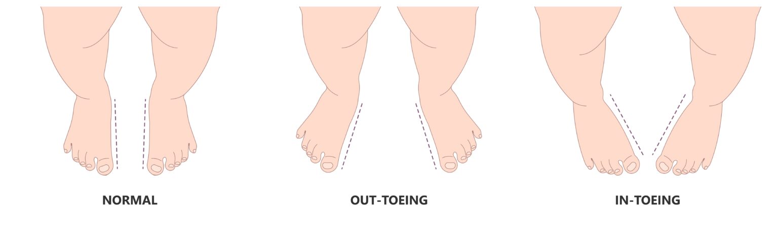 When to See a Doctor About My Child's In-Toeing and Out-Toeing ...