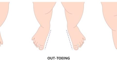 When to See a Doctor About My Child's In-Toeing and Out-Toeing ...
