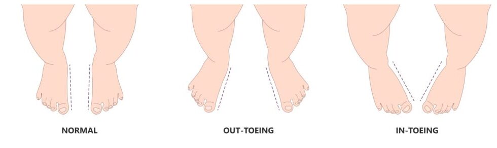 When to See a Doctor About My Child's In-Toeing and Out-Toeing ...